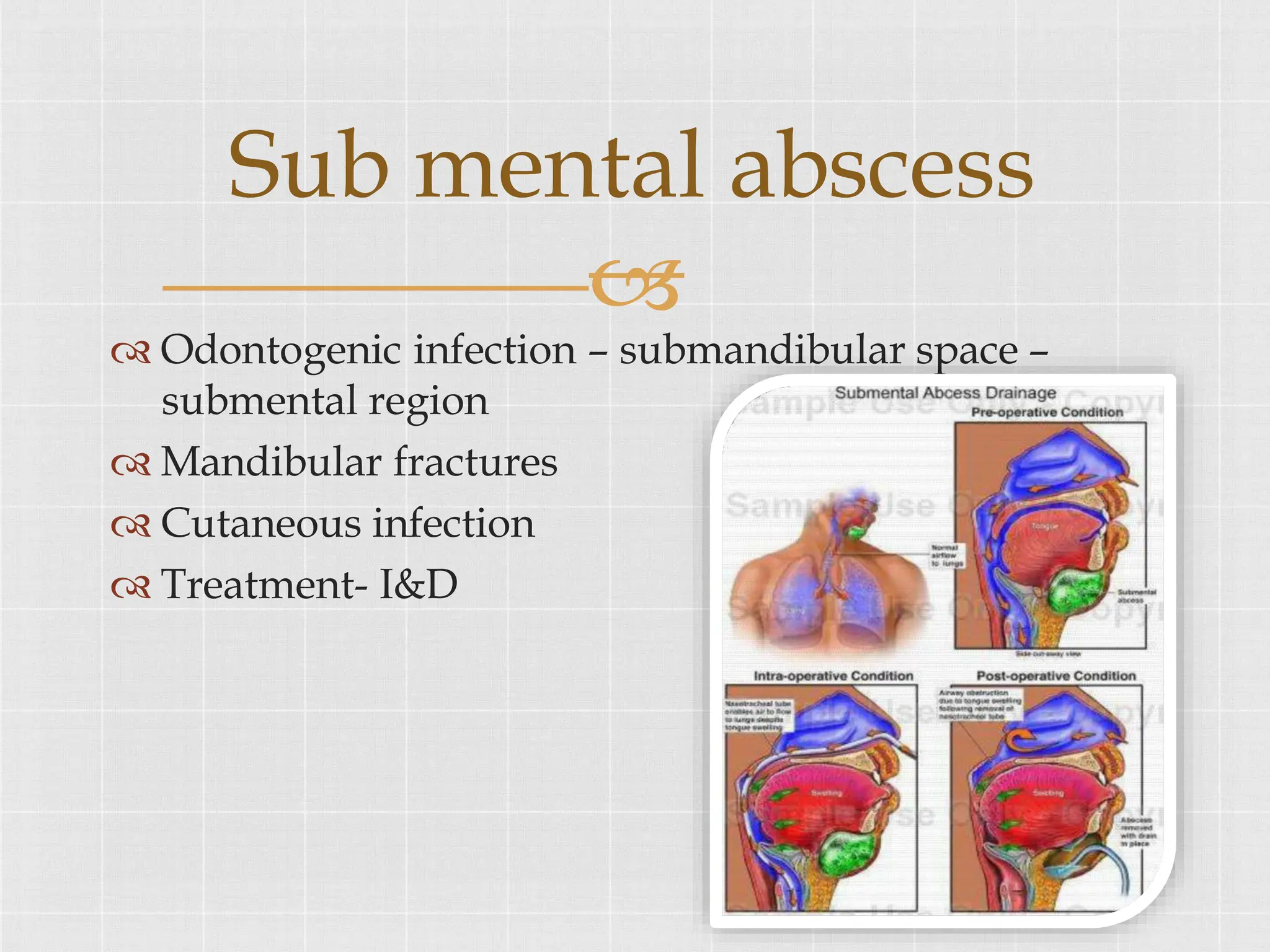 Abscesses in Ent and HEAD, NECK region .pptx
