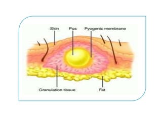 Skin Abscess Diagram