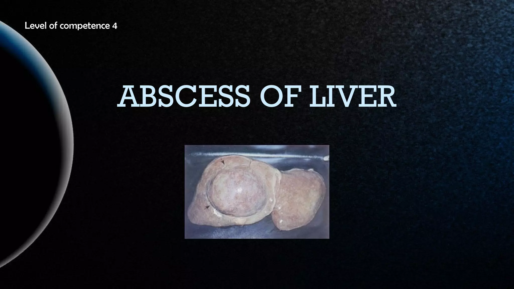 Abscess of liver | PPT