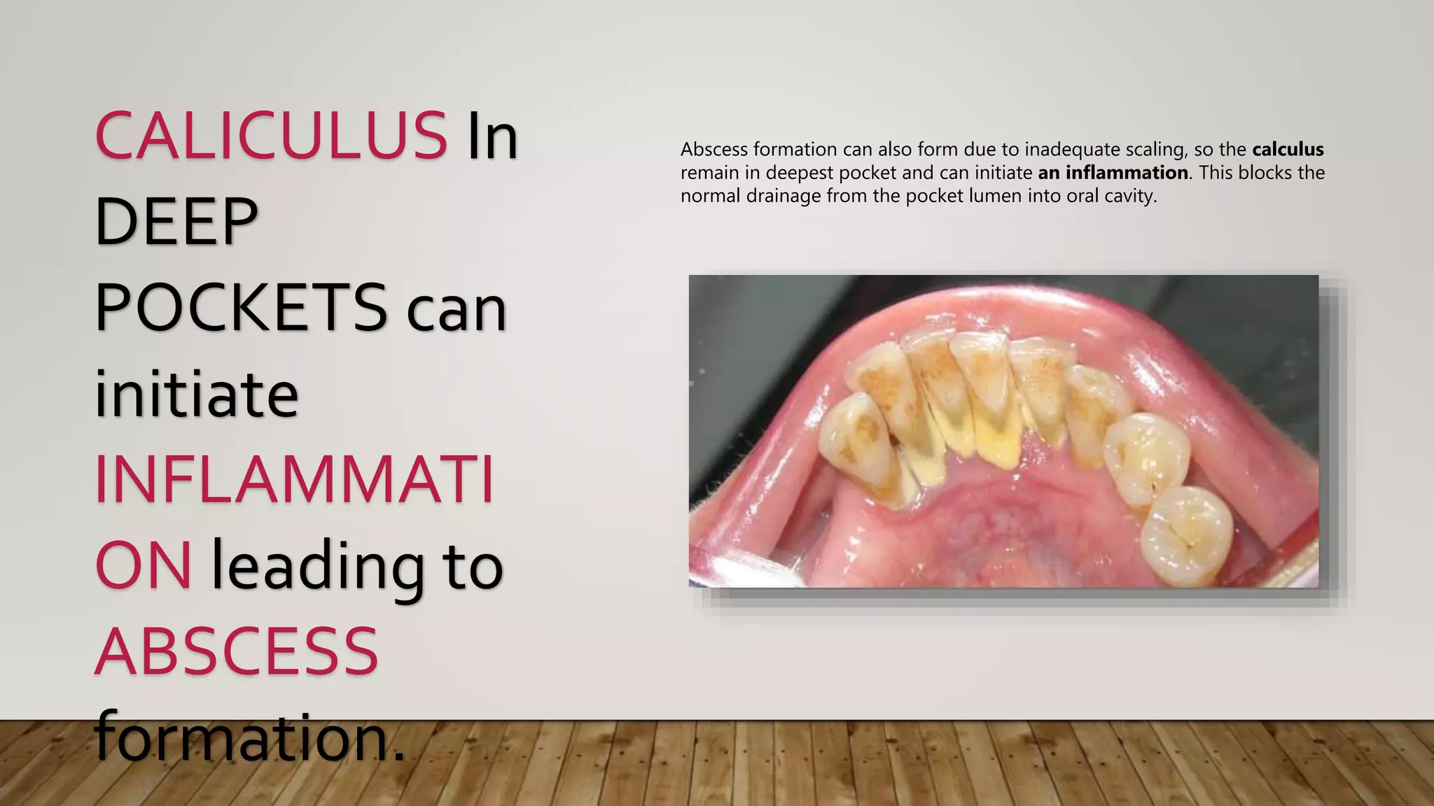 Abscess of periodontium | PPTX