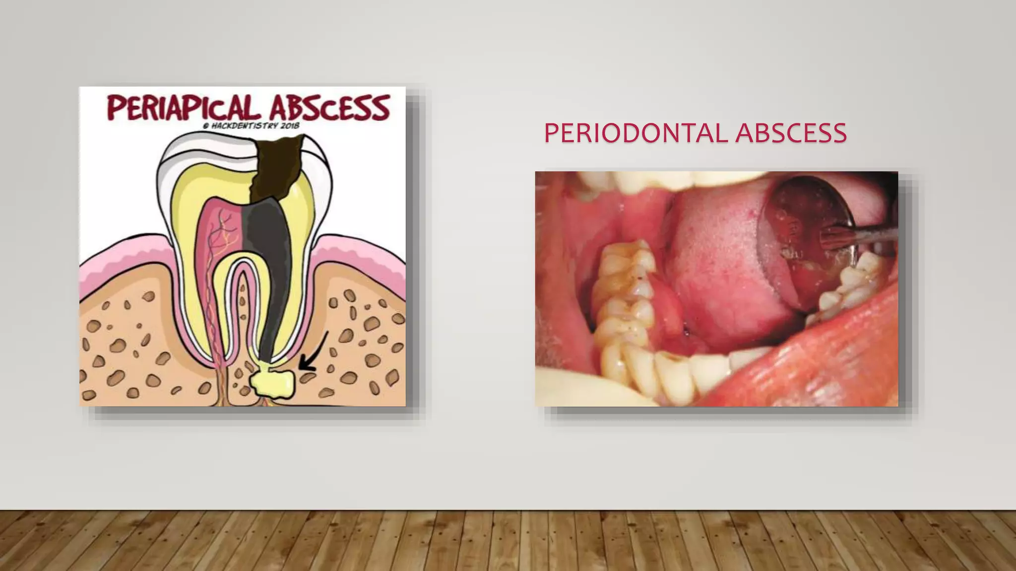 Abscess of periodontium | PPTX
