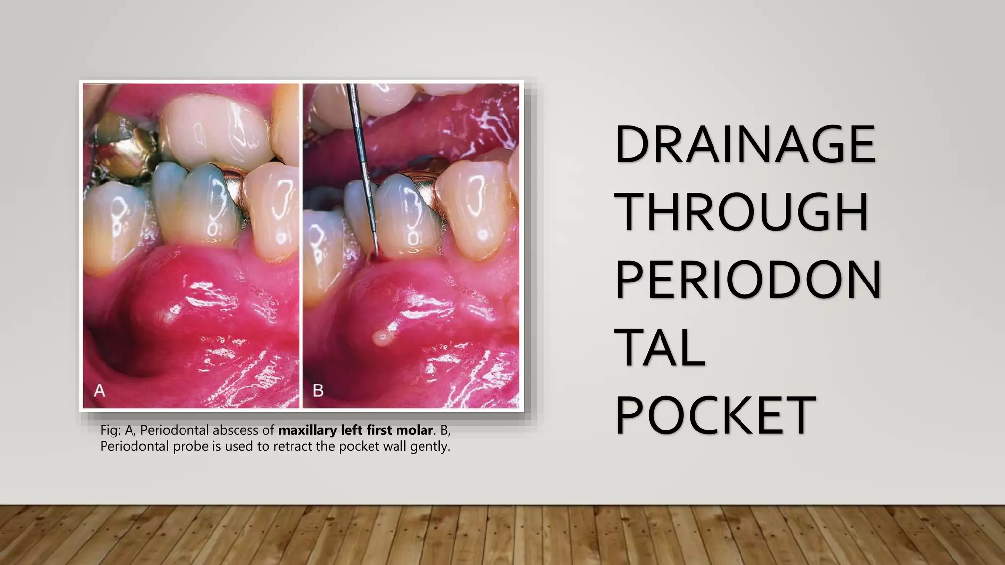 Abscess of periodontium | PPTX