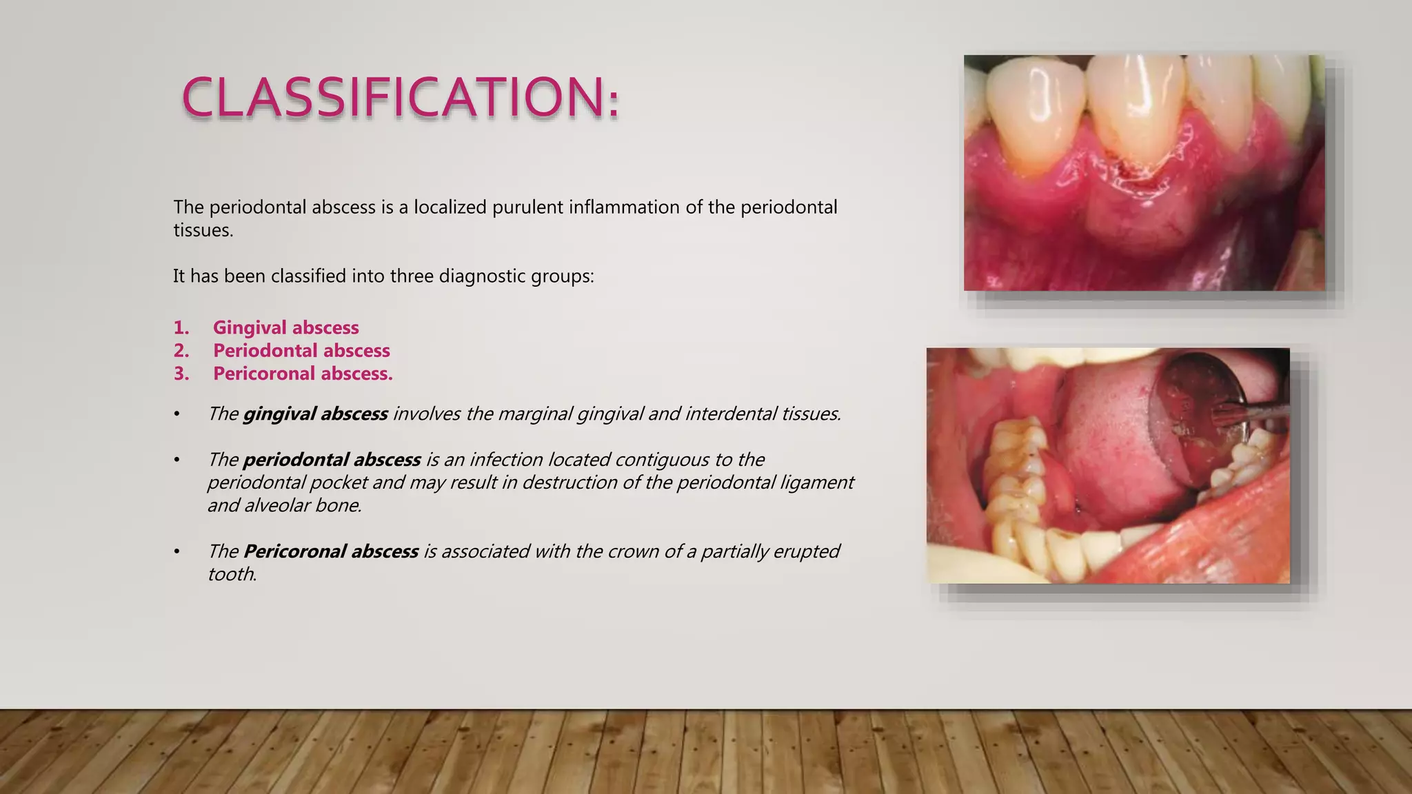 Abscess of periodontium | PPTX