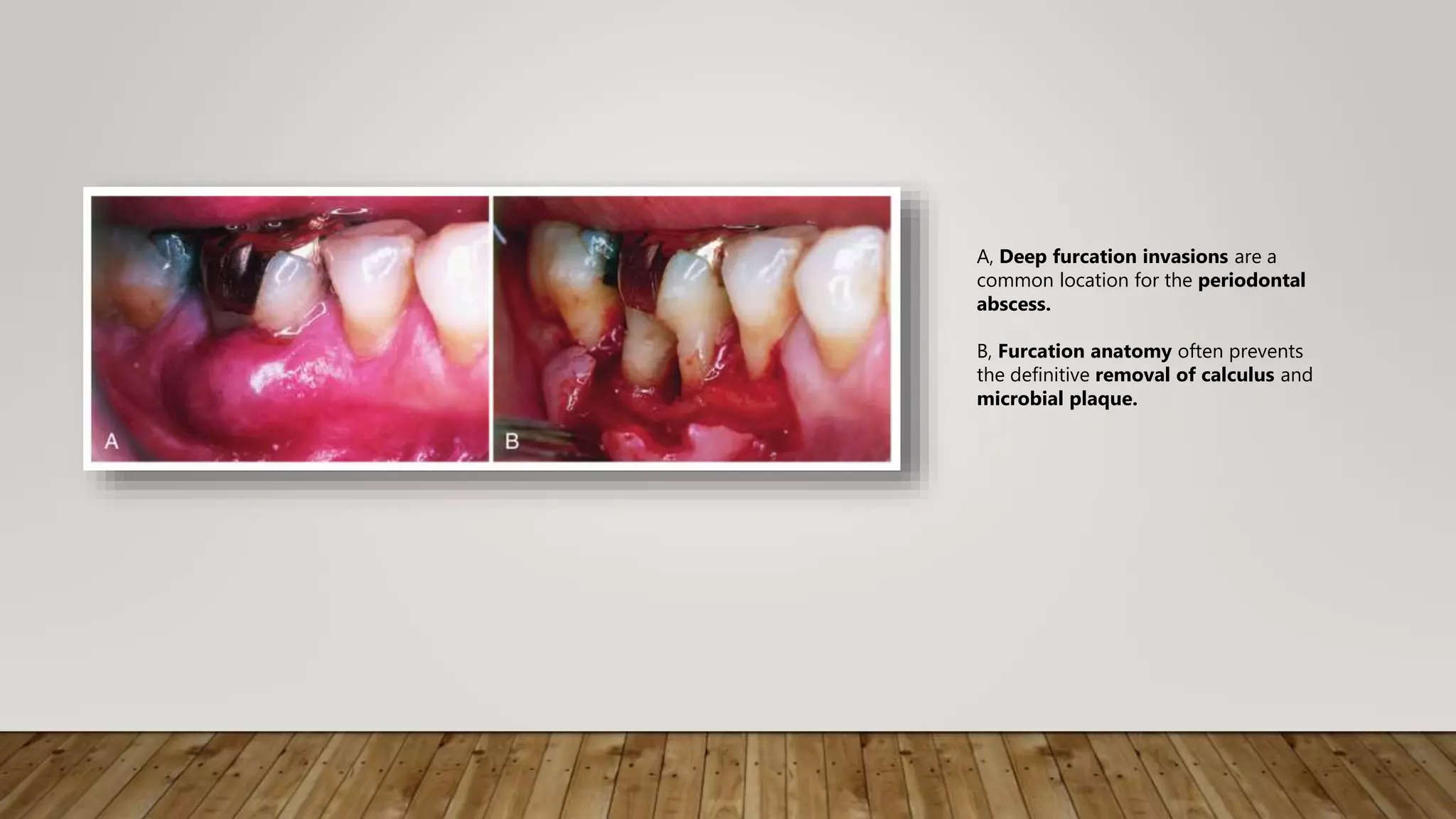 Abscess of periodontium | PPTX