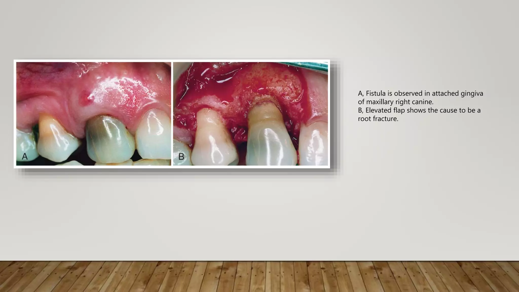 Abscess of periodontium | PPTX