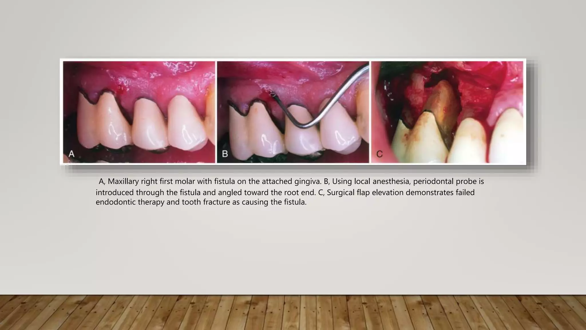 Abscess of periodontium | PPTX