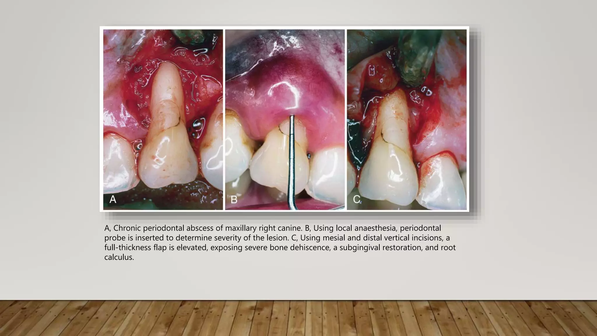 Abscess of periodontium | PPTX