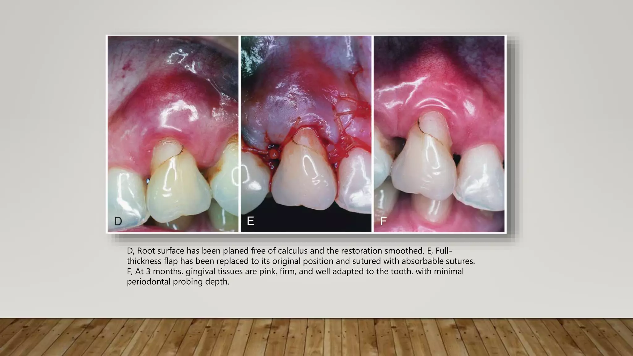 Abscess of periodontium | PPTX