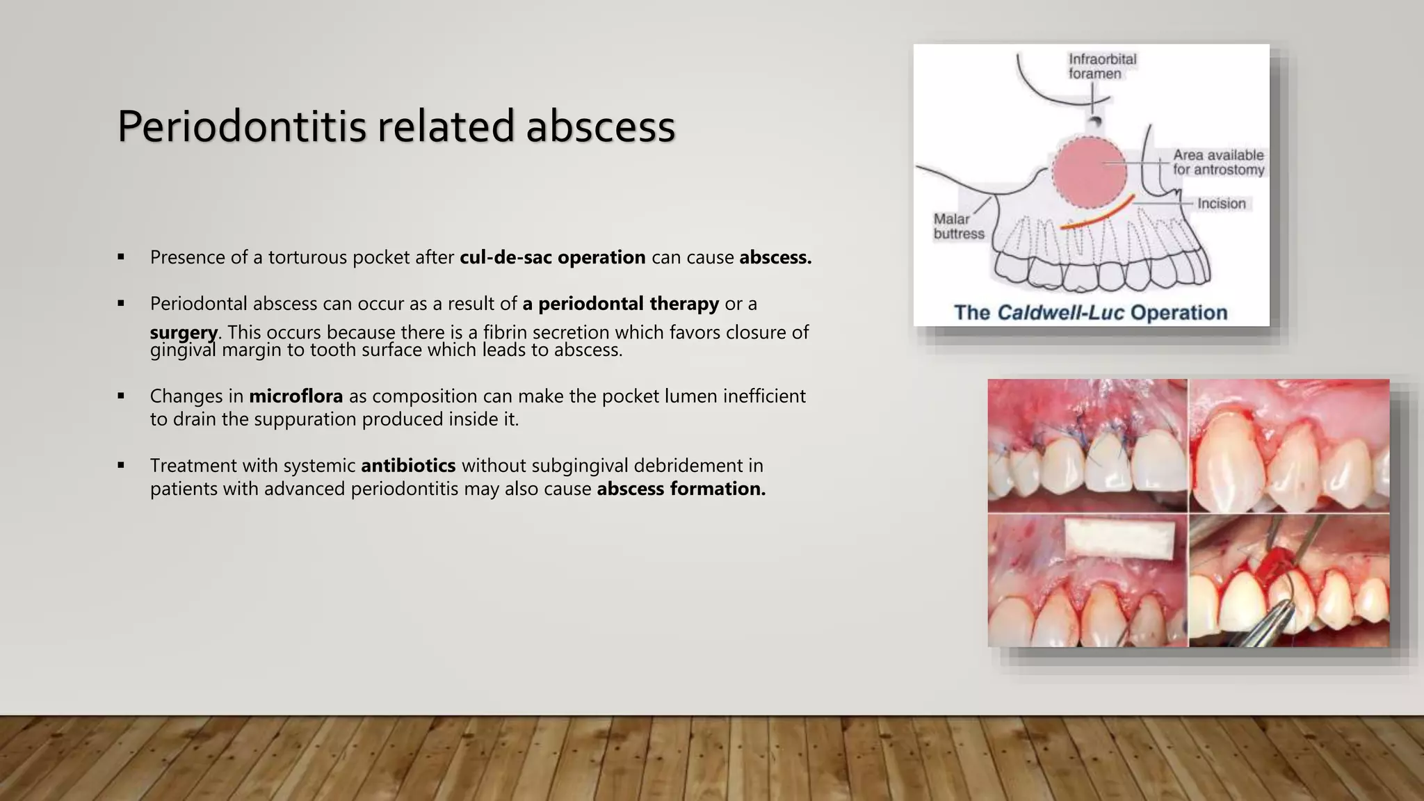 Abscess of periodontium | PPTX