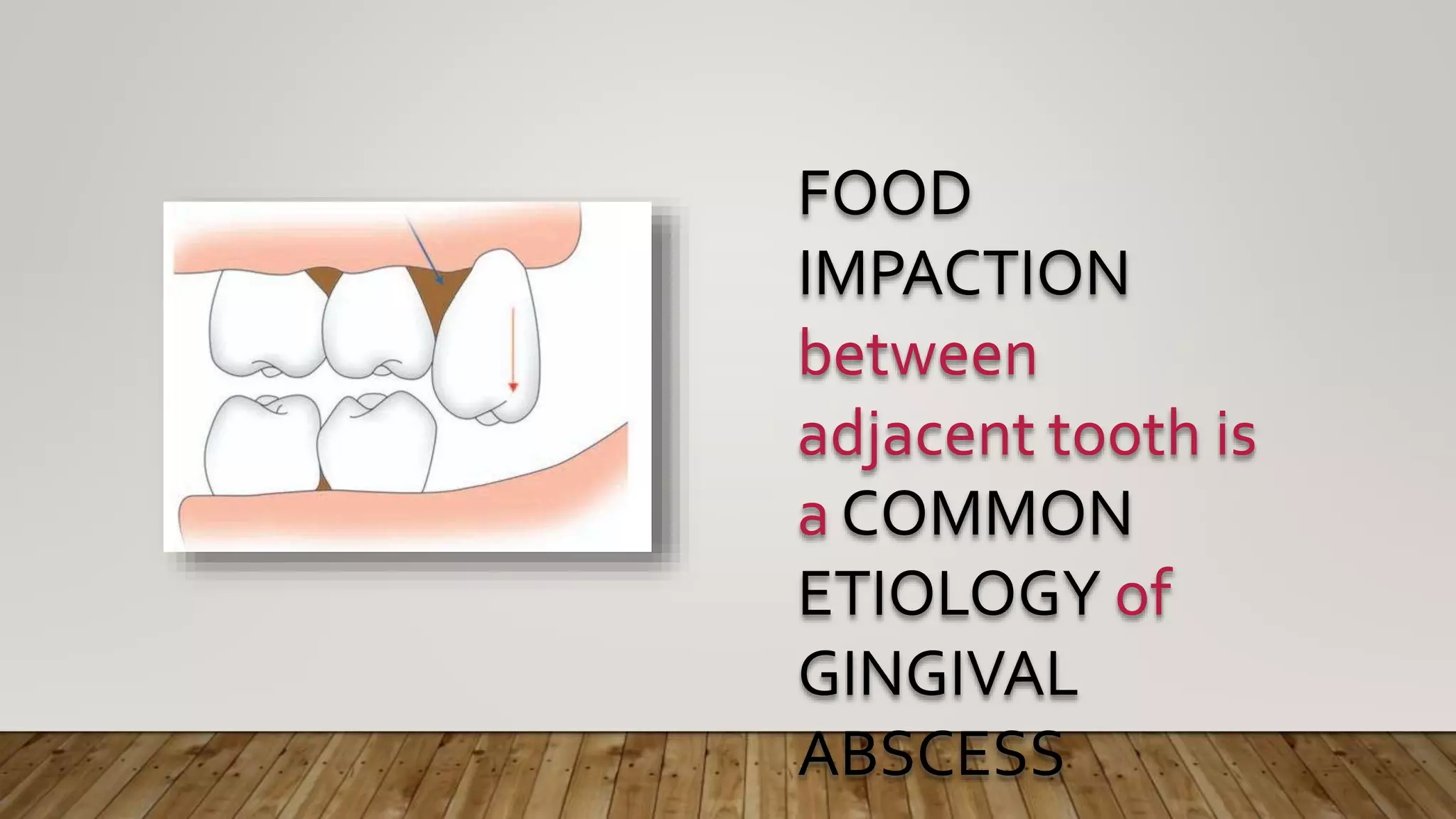Abscess of periodontium | PPTX