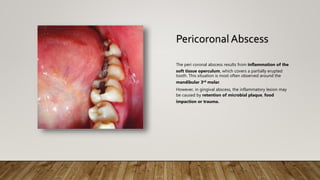 Abscess of periodontium | PPTX