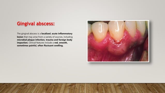 Abscess of periodontium | PPTX