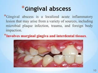 Abscess of periodontium and its management | PPTX