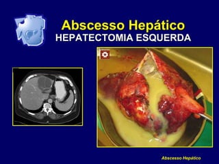 Abscesso Hepático