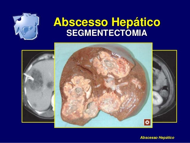 Abscesso Hepático