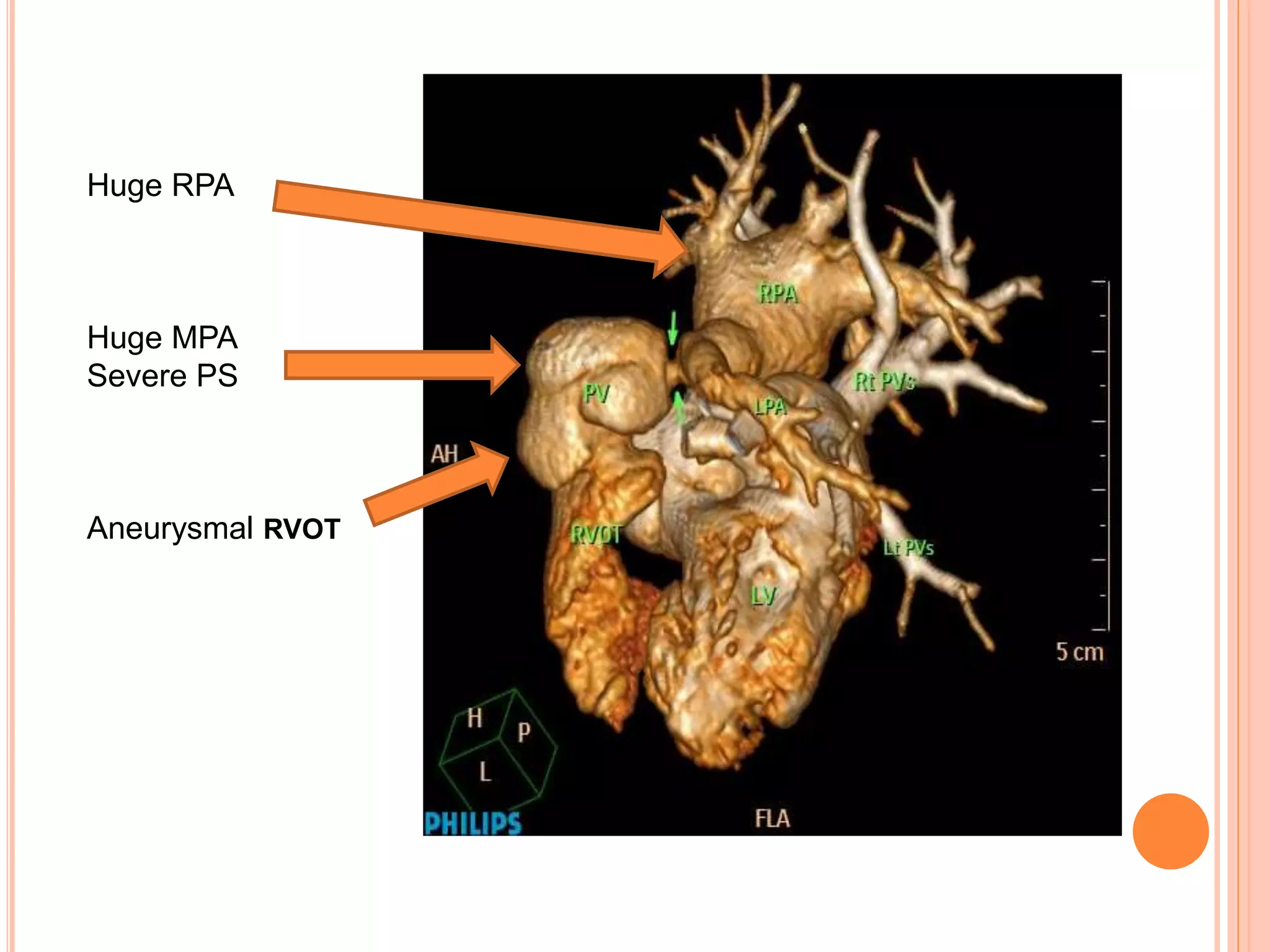 Absent pulmonary valve | PPTX