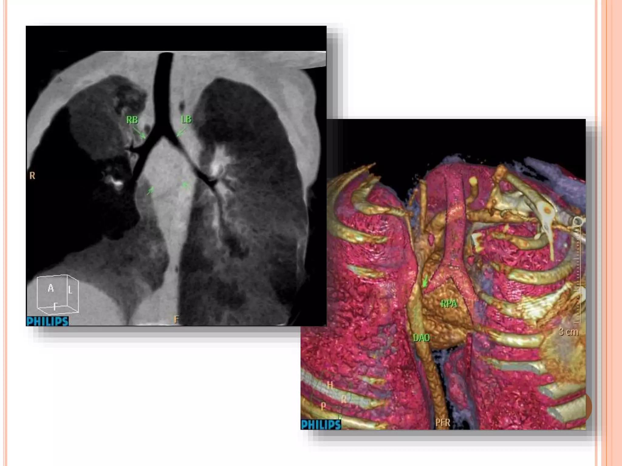 Absent pulmonary valve | PPTX
