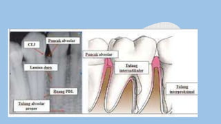 abses submandibula.pptx