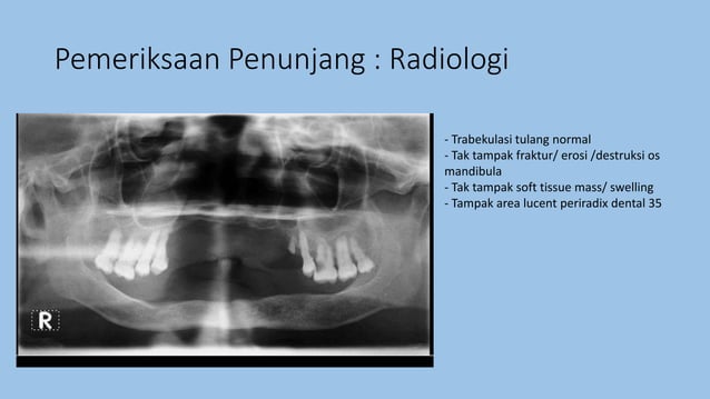 abses submandibula.pptx