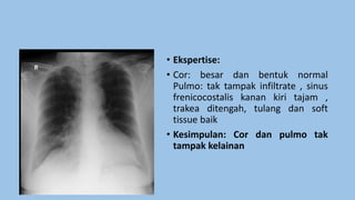abses submandibula.pptx