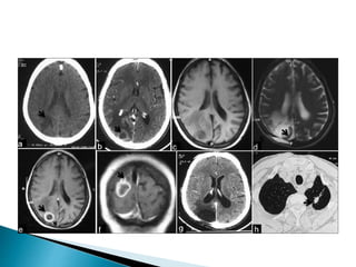 Abses Cerebri pada Pediatrik dan tatalaksananya | PPT