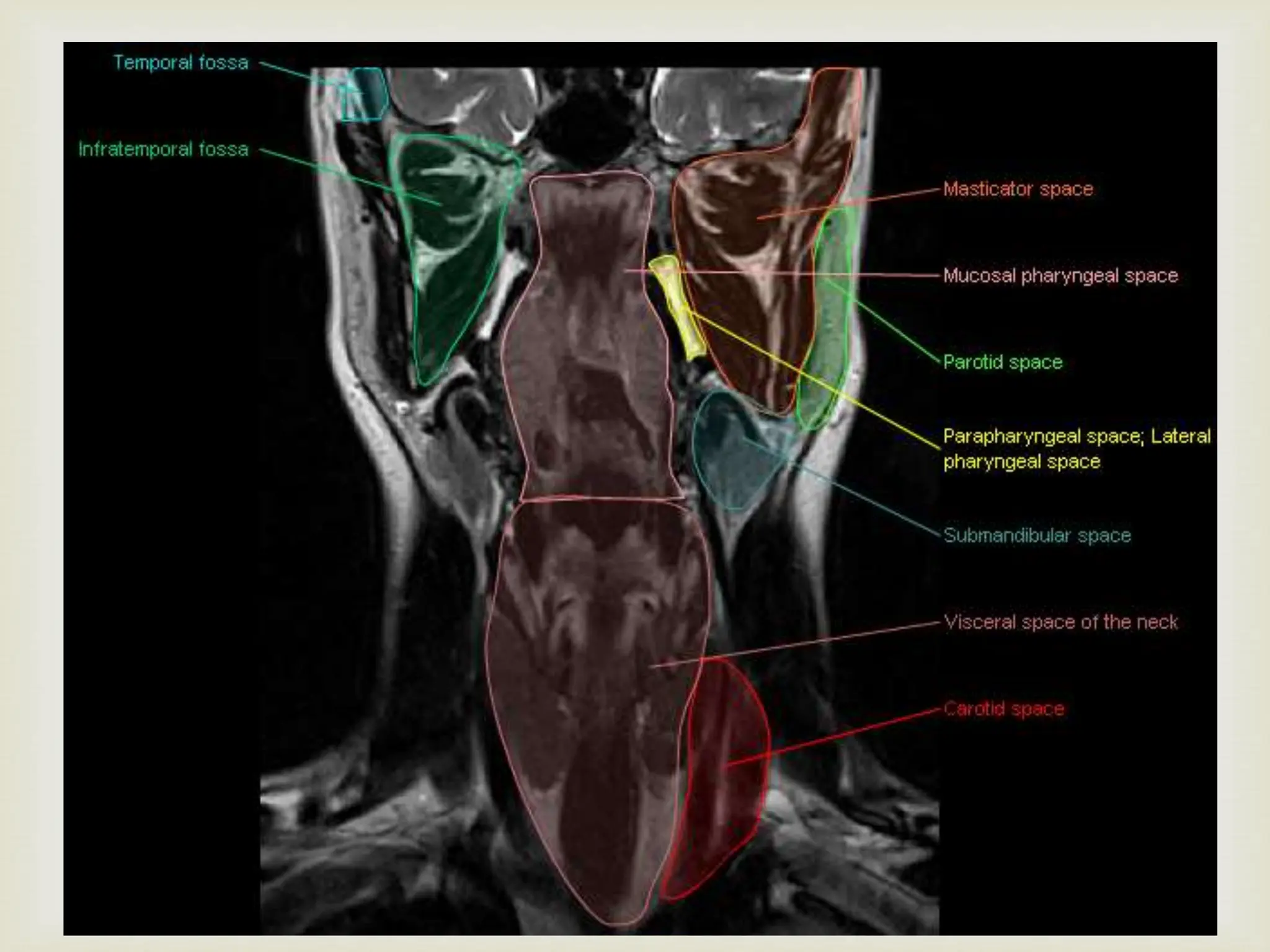 Abses_leher_dalam.pptx