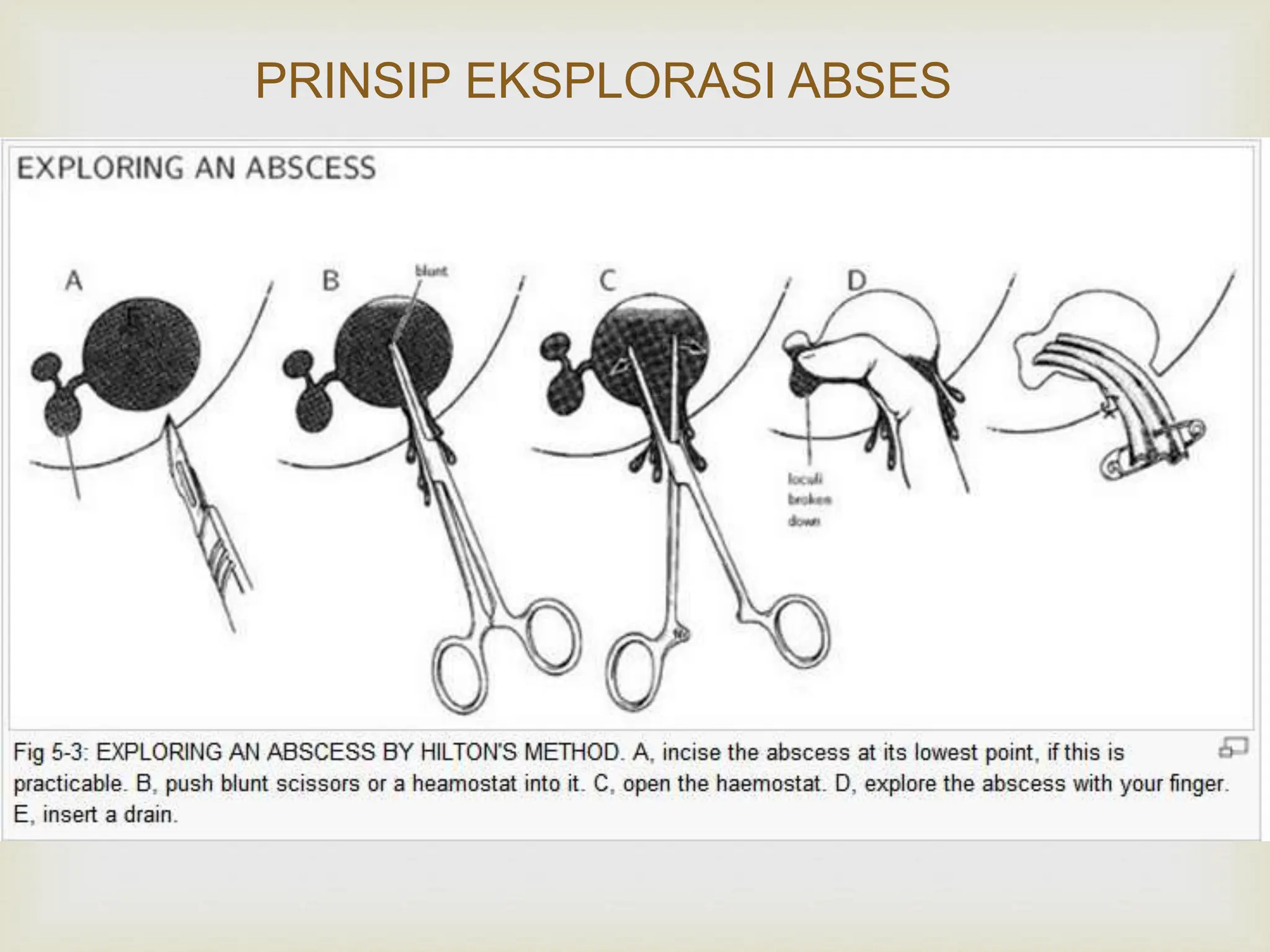 Abses_leher_dalam.pptx