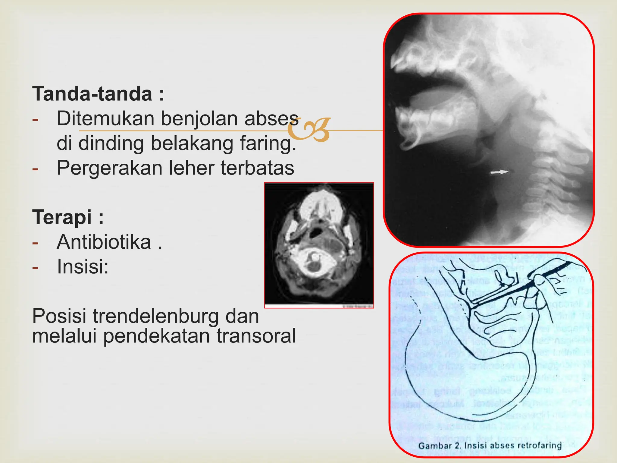 Abses_leher_dalam.pptx