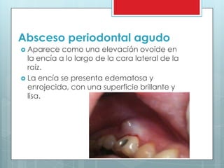 Absesos | PPTX