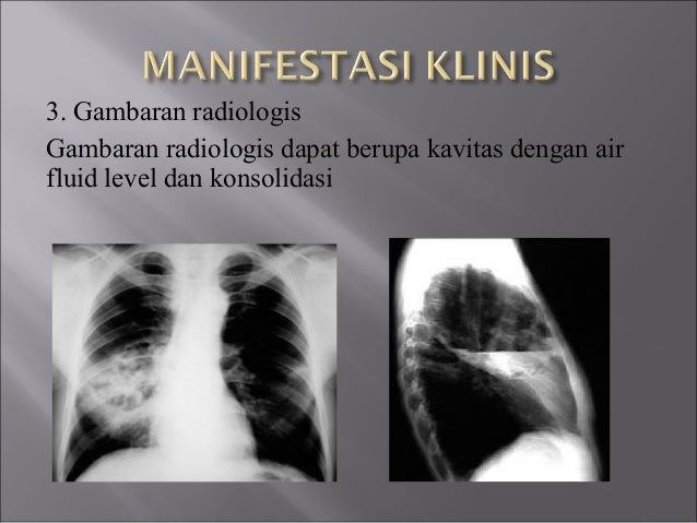 Abses paru by dr.Yanuarman