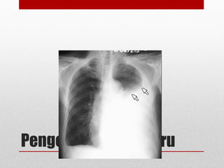 Abses paru-paru, Pleurisi dan Empyema | PPT