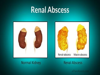 Abses renal adalah kerusakan pada ginjal yang menyebabkan kadar protein ...