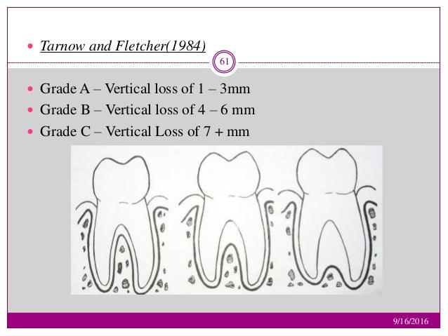 Alveolar Bone