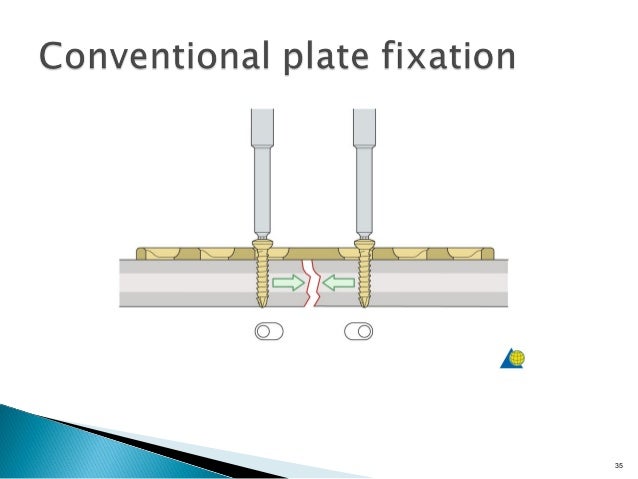 Absolute stability plate fixation