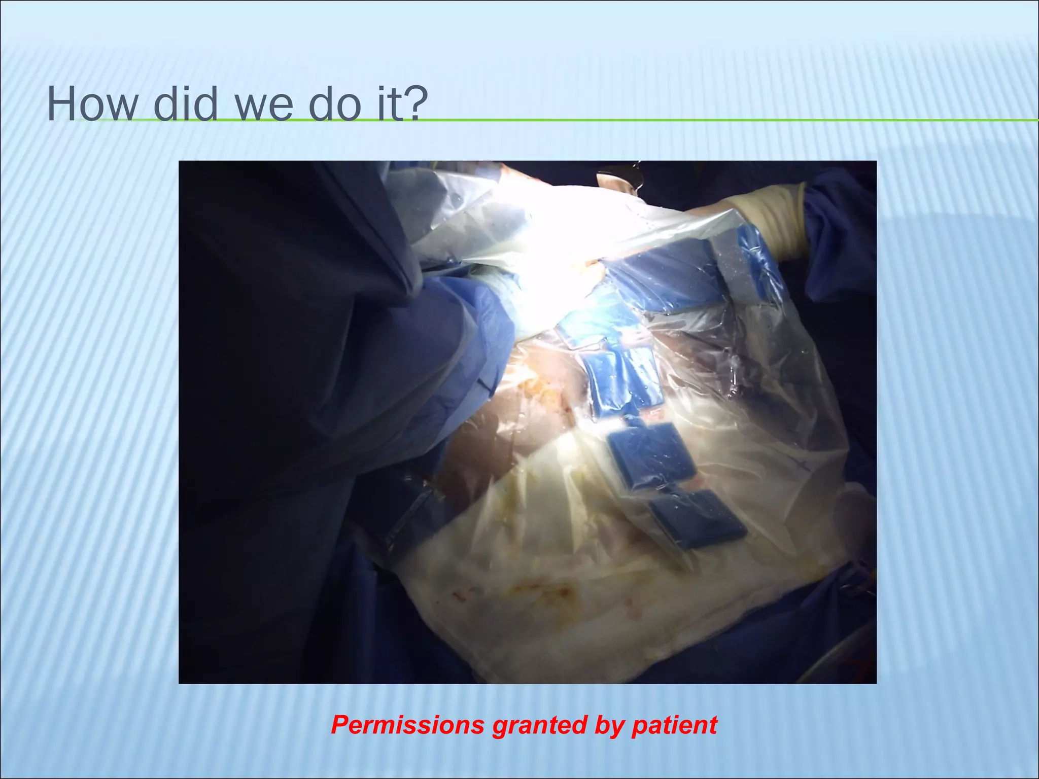 Laparostomy management - ABThera™ Open Abdomen Negative Pressure ...