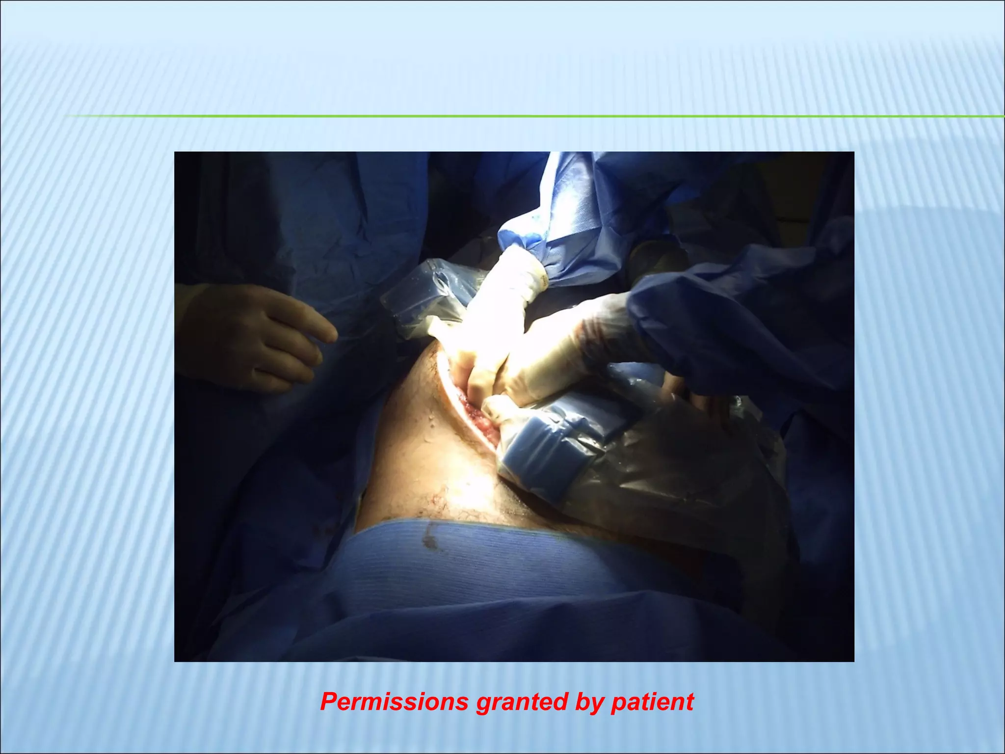 Laparostomy management - ABThera™ Open Abdomen Negative Pressure ...
