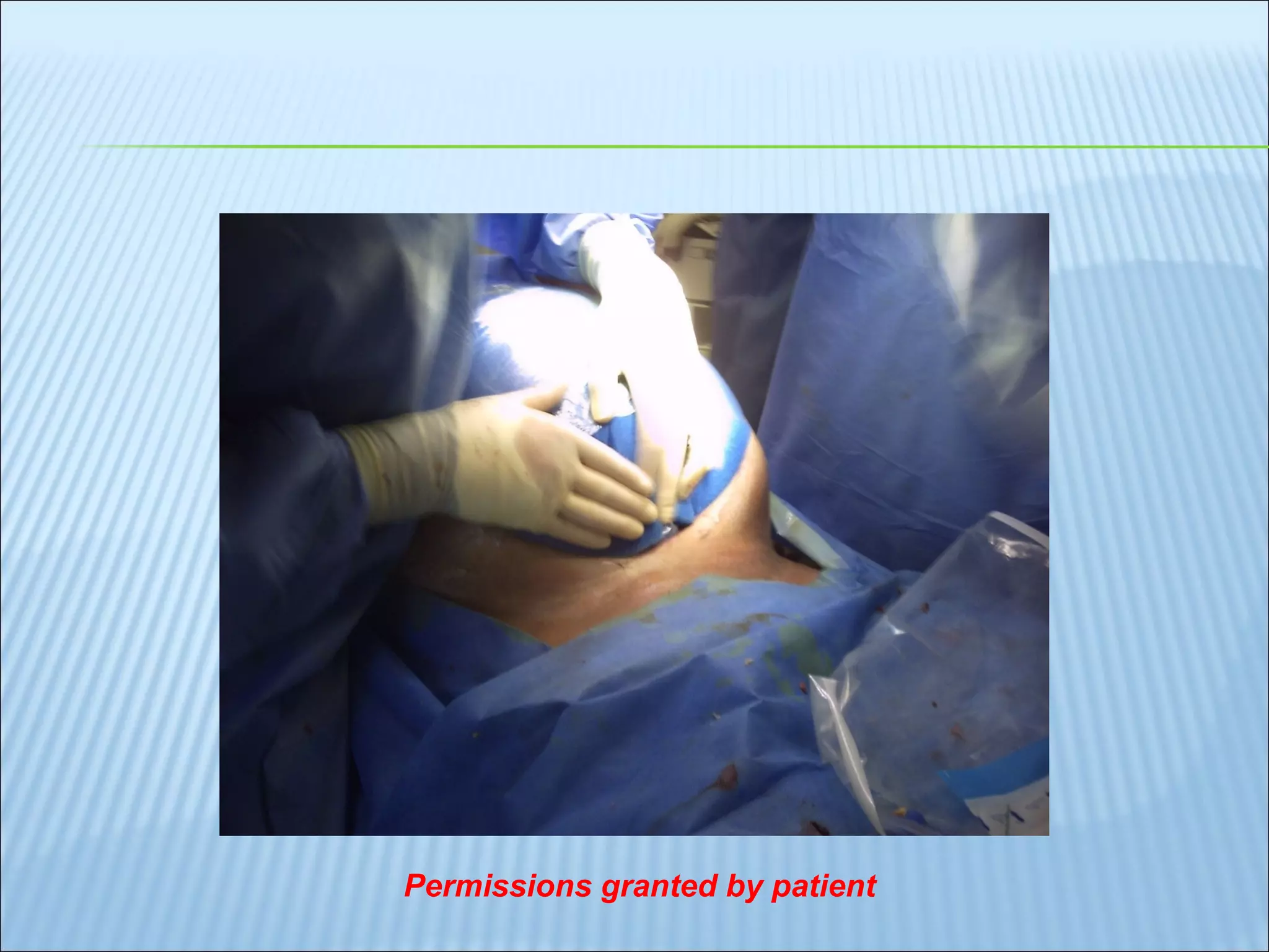 Laparostomy management - ABThera™ Open Abdomen Negative Pressure ...