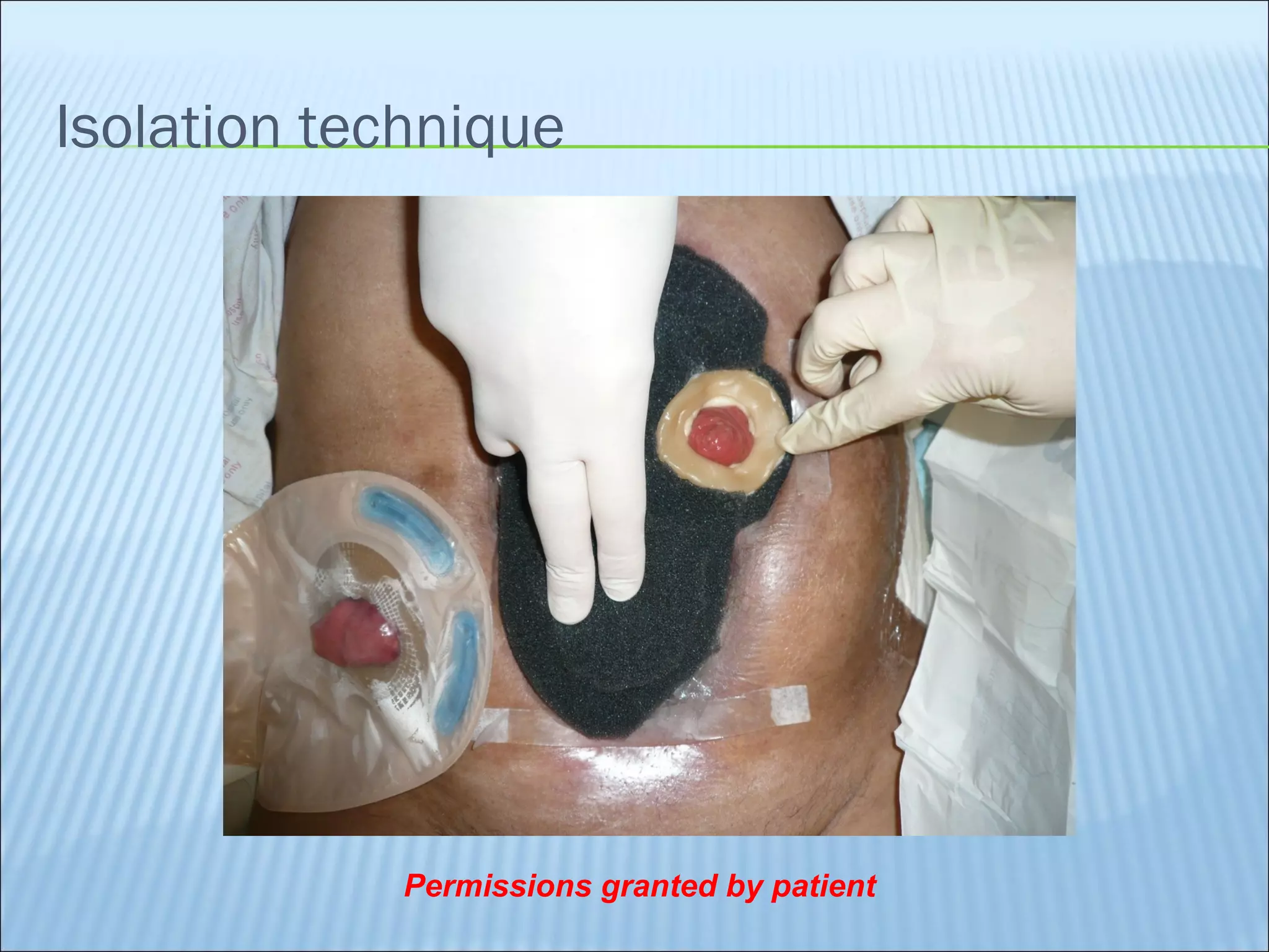 Laparostomy management - ABThera™ Open Abdomen Negative Pressure ...