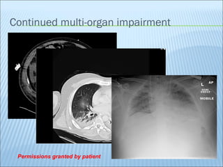 Laparostomy management - ABThera™ Open Abdomen Negative Pressure ...