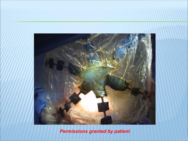 Laparostomy management - ABThera™ Open Abdomen Negative Pressure ...