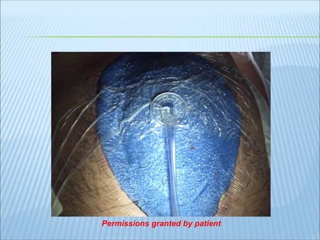 Laparostomy management - ABThera™ Open Abdomen Negative Pressure ...