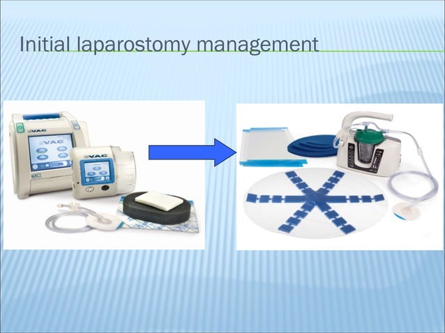 Laparostomy management - ABThera™ Open Abdomen Negative Pressure ...
