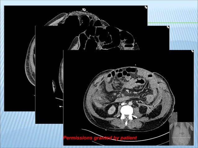 Laparostomy management - ABThera™ Open Abdomen Negative Pressure ...
