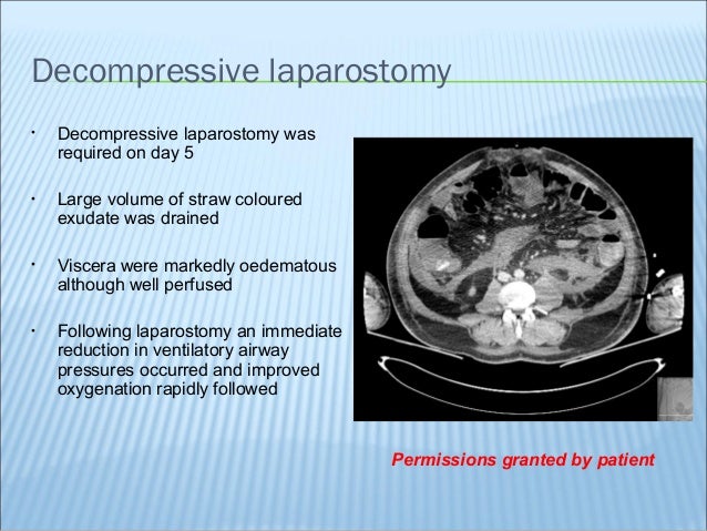 Laparostomy management - ABThera™ Open Abdomen Negative Pressure Ther…