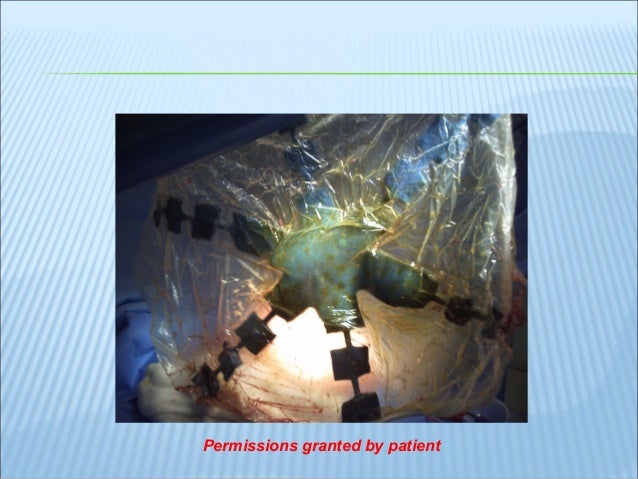 Laparostomy management - ABThera™ Open Abdomen Negative Pressure Ther…