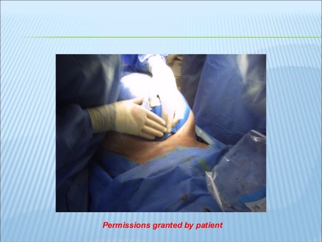 Laparostomy management - ABThera™ Open Abdomen Negative Pressure Ther…