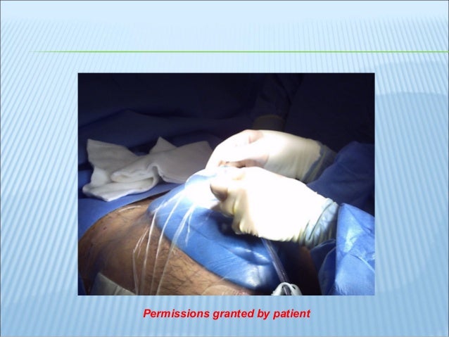 Laparostomy management - ABThera™ Open Abdomen Negative Pressure Ther…