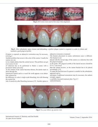 Congenitally Missing Lateral Incisors; Orthodontic, Restorative, and ...