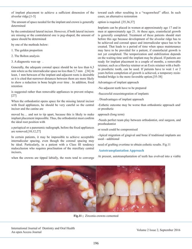 Congenitally Missing Lateral Incisors; Orthodontic, Restorative, and ...