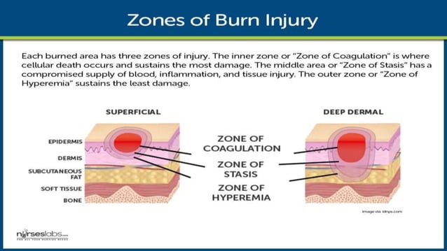 Nursing management of burn patient | PPTX